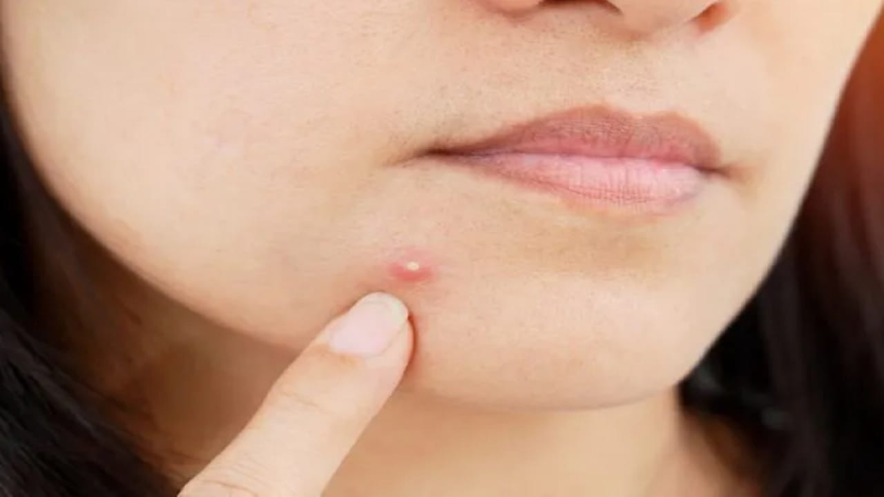Summer : उन्हाळ्यात पिंपल्सची समस्या दूर करण्यासाठी या टिप्स फाॅलो करा ...