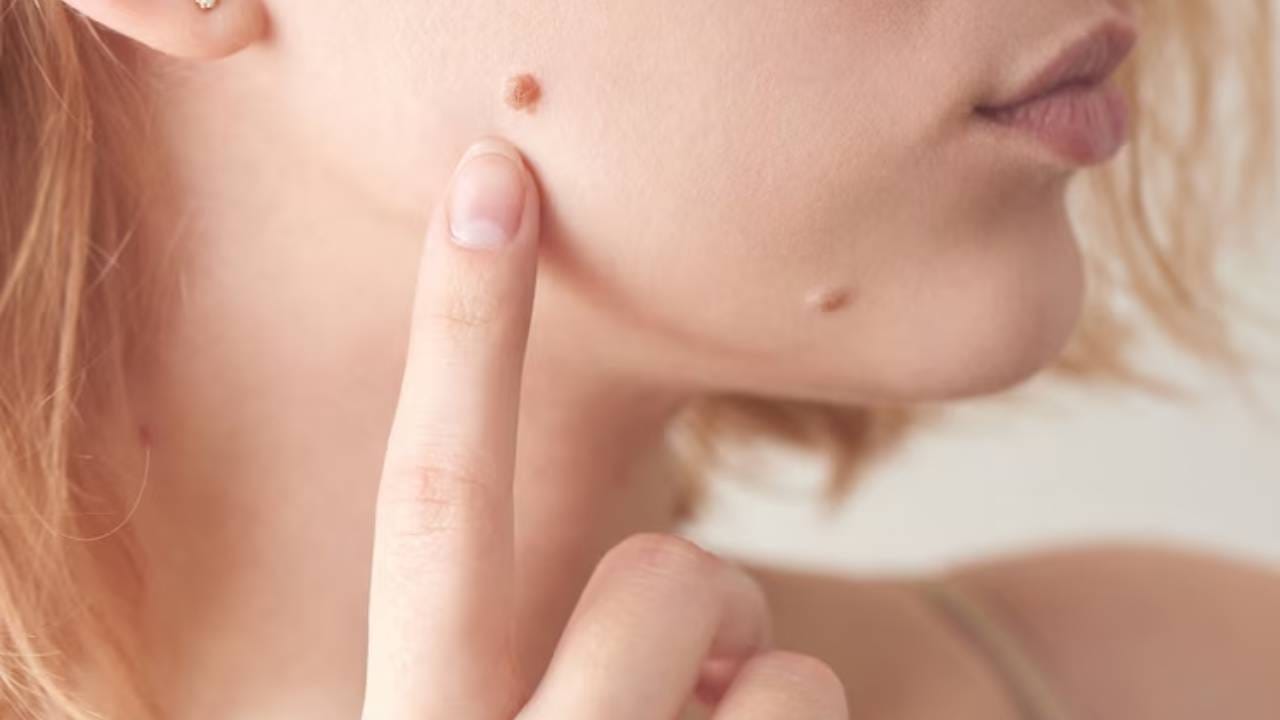आपल्या शरीरावर दिसणाऱ्या तिळाचे कारण काय ? - Marathi News | Know the ...
