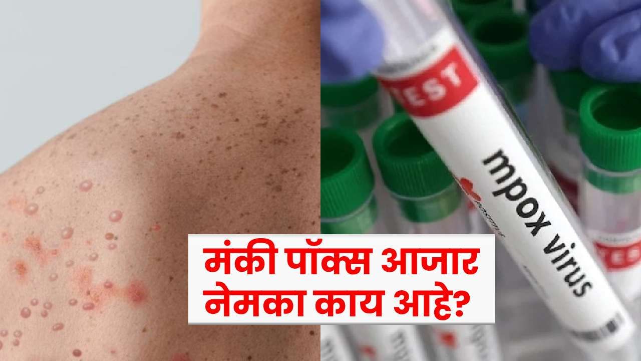 मंकीपॉक्स कसा पसरतो? तुम्ही कशी काळजी घ्या? - Marathi News | How ...